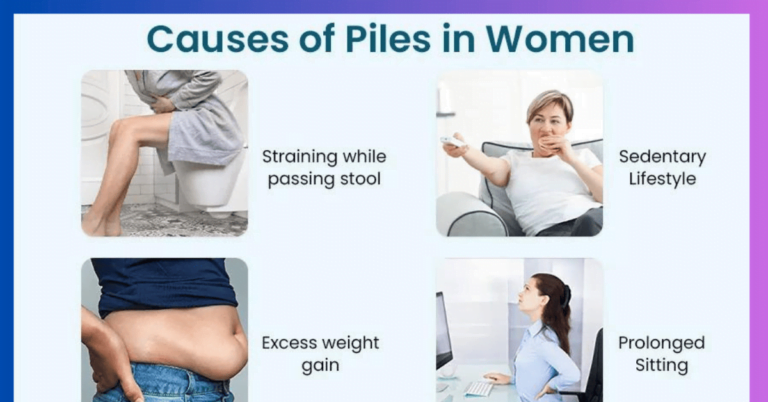 Piles In Women: 6 Causes, Symptoms, Pictures, And Best Treatments