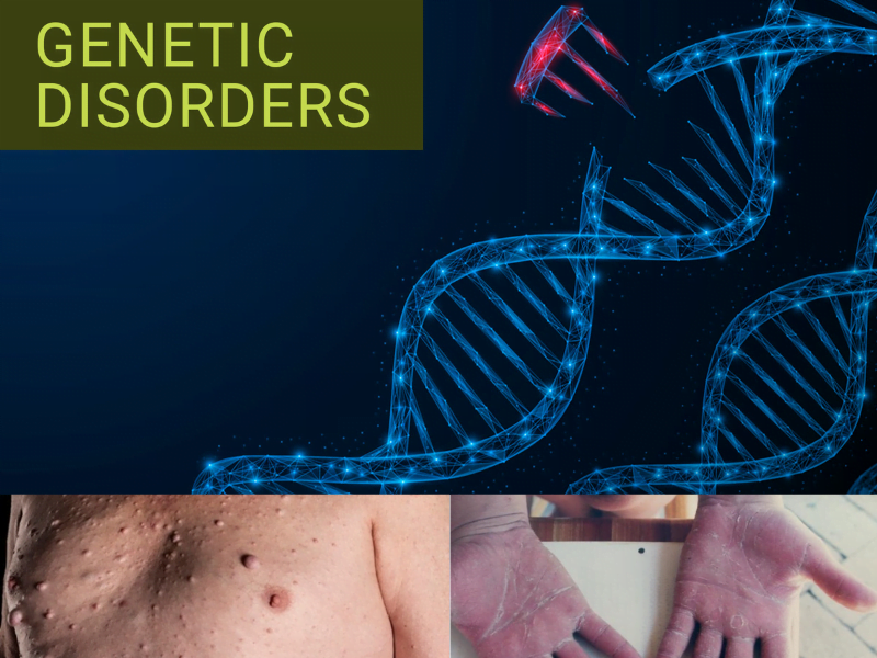 Genetic Disorders: 4 Common Genetic Disorders